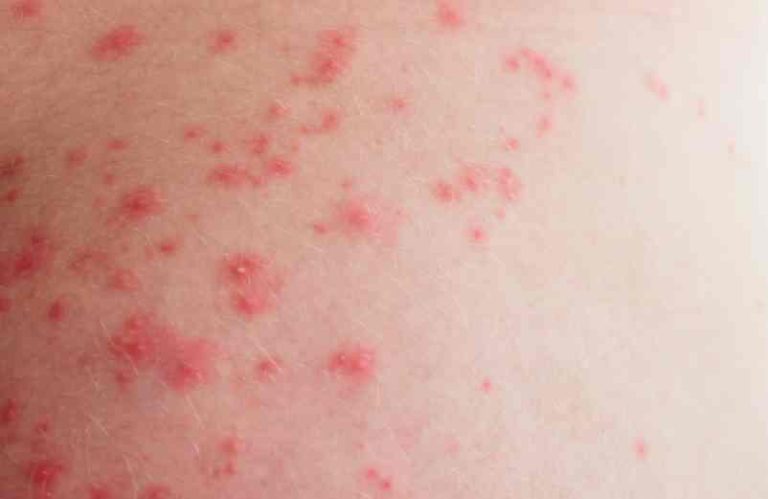 Angiome rubis : Comment s’en débarrasser ? - Ortho Doc France